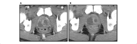 Transverse Image Of Complex Prostatic Abscess In Our Patient At Download Scientific Diagram