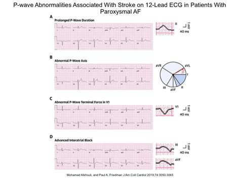 Abnormal 12 Lead Ecg