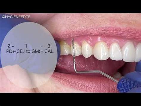 What Does Cal Mean In Dentistry