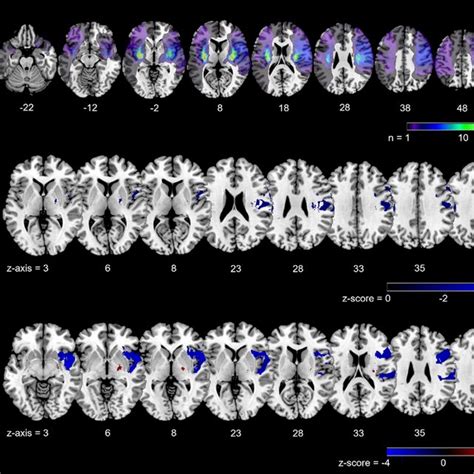 Lesion Mapping Lesion Locations Of All 45 Patients A VLSM Results