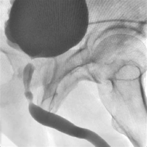 Preoperative Ascending Urethrogram Showing Bladder Neck Contracture Download Scientific Diagram