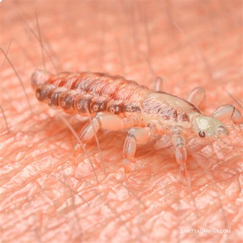 What Do Genital Crabs Look Like Pubic Lice Pubic Crab Pediculosis