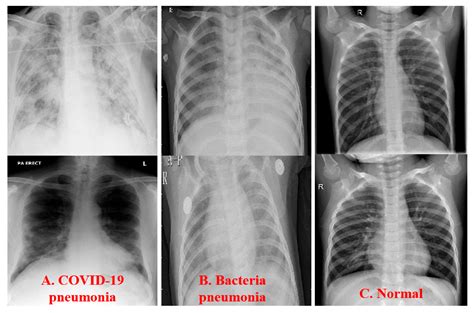 Healthcare Free Full Text Fusion Extracted Features By Deep Networks For Improved COVID 19