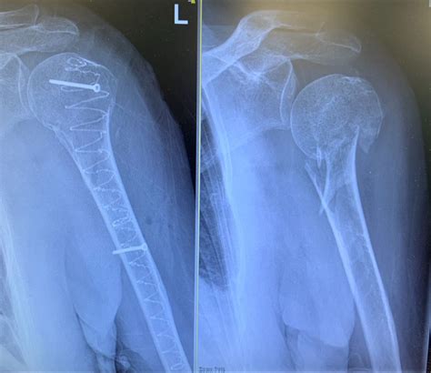 Yousef Adam On Linkedin 74 Y Old With Subcapital Humerus Fracture