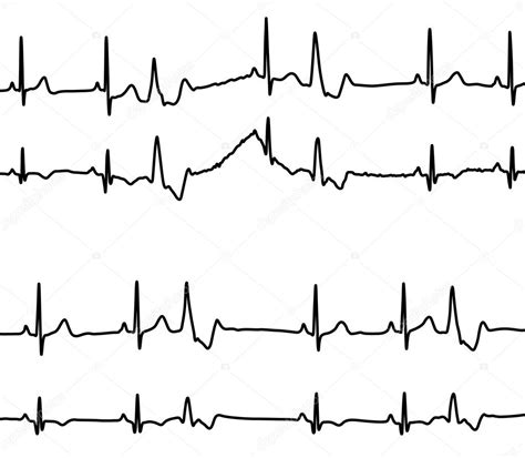 Heart Diseases Graphs Stock Vector Bambuh
