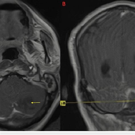 Postoperative MRI Of The Brain T1 Weighted Postcontrast Imaging In The