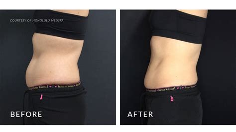 Coolsculpting Plus Fat Reduction And Body Scultping