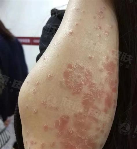 白癜風常見併發症有哪些這七大併發症切不可忽視 每日頭條