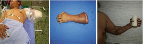 Fundamentals Of Hand And Finger Amputations Springer Nature Link
