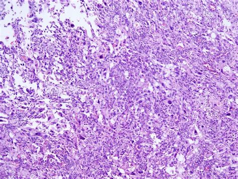 High Power Field Image Showing The He Staining Of Ovarian Angiosarcoma