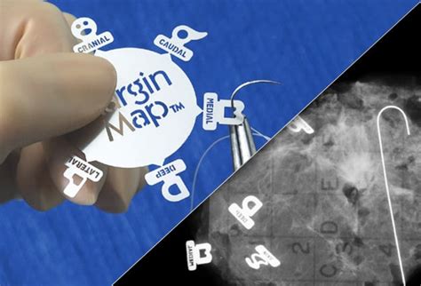 Benefits Of A Standardized System For Breast Specimen Orientation