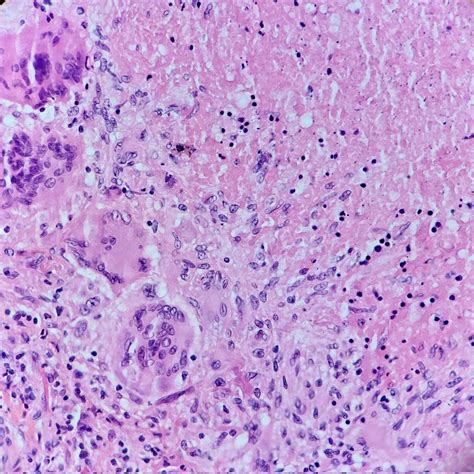 Miliary Tuberculosis Histology
