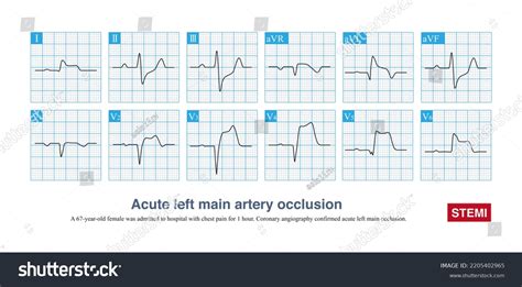 St Segment Elevation Strip