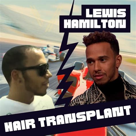 Elon Musk Hair Transplant Before And After Transformation