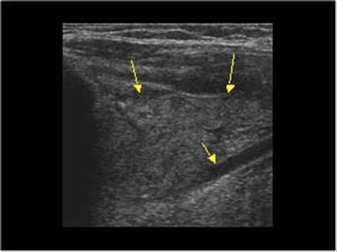 Whartons Ducts Inflamed
