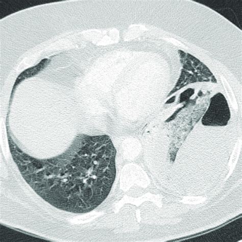 Lung Window Shows Left Lower Lobe Complex Collection That Includes