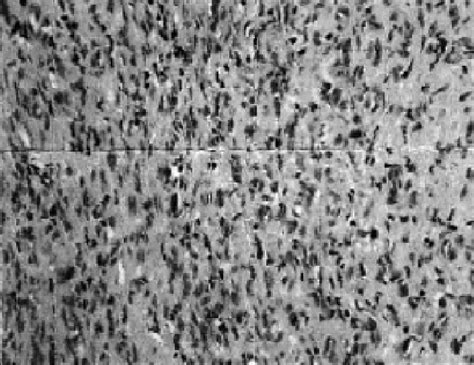 Hematoxylin Eosin Staining Showing No Multinucleated Giant Cells