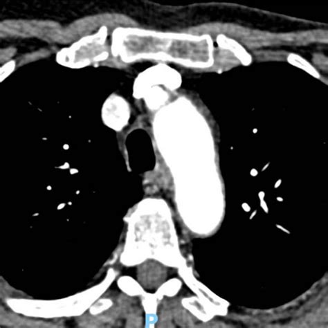 Computer Tomography Scanner Showing Tissue Infiltration Thickening