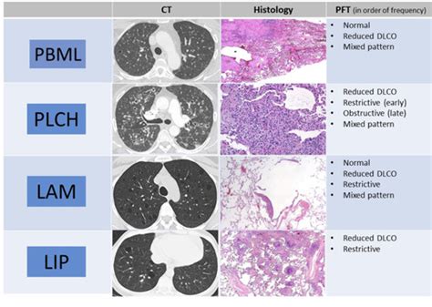 Pulmonary Benign Metastasizing Leiomyoma PBML Flashcards Quizlet