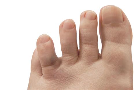 Awesome Tips About How To Tell If Your Toes Are Broken Waterask