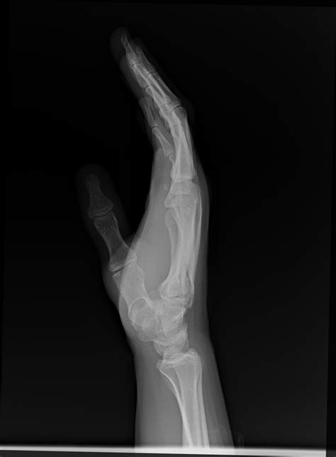 Forth Metacarpal Fracture Image