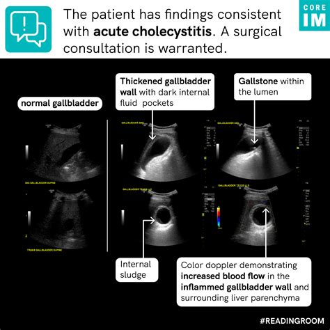 Acute Cholecystitis Ultrasound