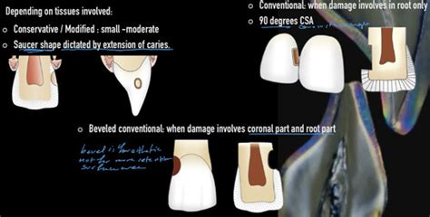 Class Iii Composite Restoration Flashcards Quizlet Class Iii Composite Restoration Flashcards Quizlet