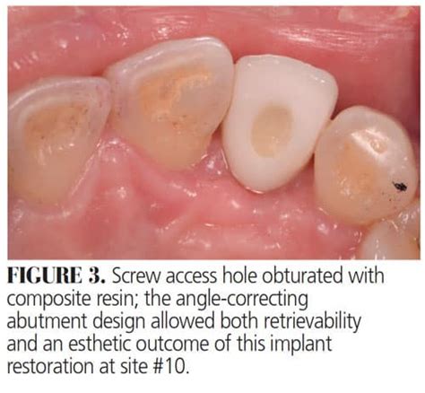Deciding Between Screw Retained Or Cemented Implant Restorations