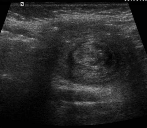 Imaging In Intussusception Sinaiem