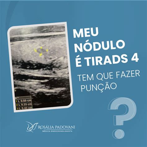 Nódulo Ti Rads 4 Tem Que Gazer Ponçāo Dra Rosália Padovani