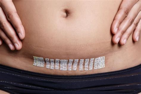What To Expect After A Hysterectomy Darin L Weyhrich Md Obgyn
