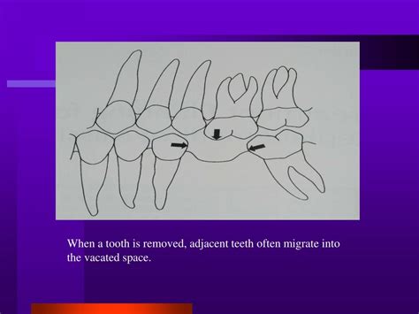 PPT 第十三章 固定桥 Chapter four Fixed Partial Denture Fixed bridge PowerPoint Presentation ID