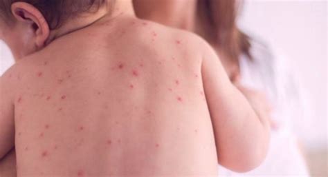 Улаанбурхан өвчнөөр өвчилсөн хоёр тохиолдол бүртгэгджээ Mnews Mn