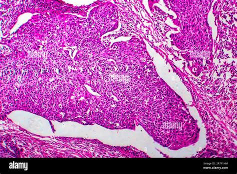 Cervical Cancer Light Micrograph Lm Of A Section Through A Squamous