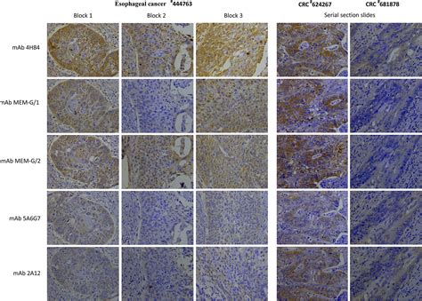 Frontiers Intratumor Heterogeneity Of Hla G Expression In Cancer Lesions