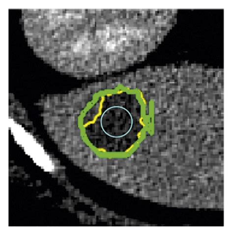 Tumor Segmentation Using The Proposed Method DRLS With Two Different