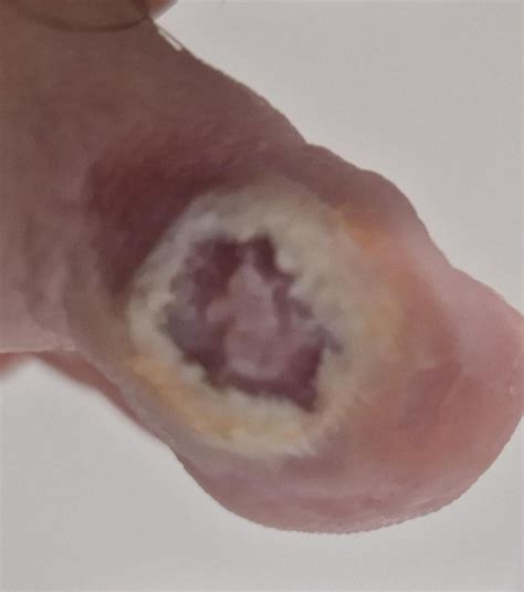 Nasty Toe Wart Updates Rwarts