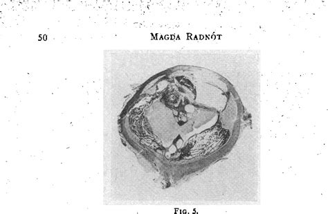 Figure 5 From Data On The Occurrence Of Calcification In The Eye