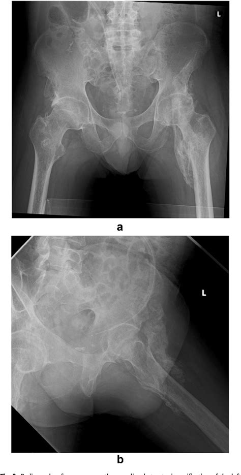 Figure 1 From Embolization Followed By Resection Of The Heterotopic Hip