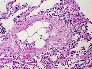 Information about rare bone diseases | Musculoskeletal Issues articles ...