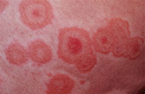 Erythema Multiforme Causes Symptoms Treatment Complications And