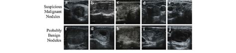 Ultrasonographic Features Of Malignant A E And Benign F J Thyroid Download Scientific