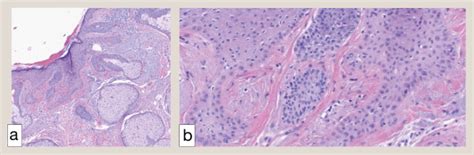 A Diagnostic Approach To Basaloid Neoplasms Of The Skin Squamous Is Red Basals Are Blue But