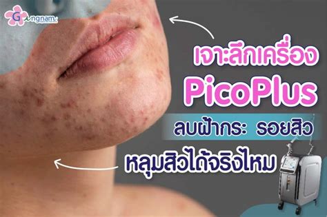 Pico Laser คืออะไร มีกี่แบบ ช่วยเรื่องอะไรบ้าง ทำที่ไหนดี