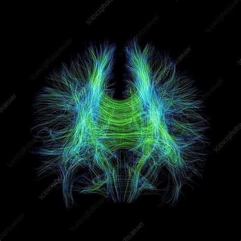 Brain Fibres Dti Mri Scan Stock Image C017 7099 In 2023 Mri Scan