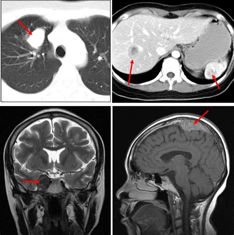 Inflammatory Pseudotumour Lung Liver Spleen And Brain Involvement