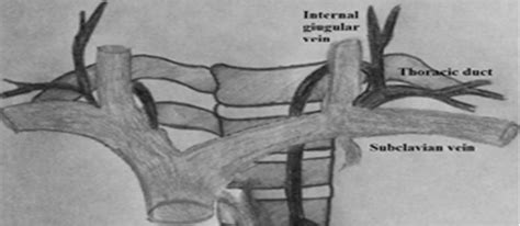 Chyle Leak Following Neck Dissection Could Radiotherapy Be Journal Of Craniofacial Surgery