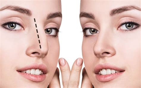 Rinoplastia qué debes saber antes de someterte a ella