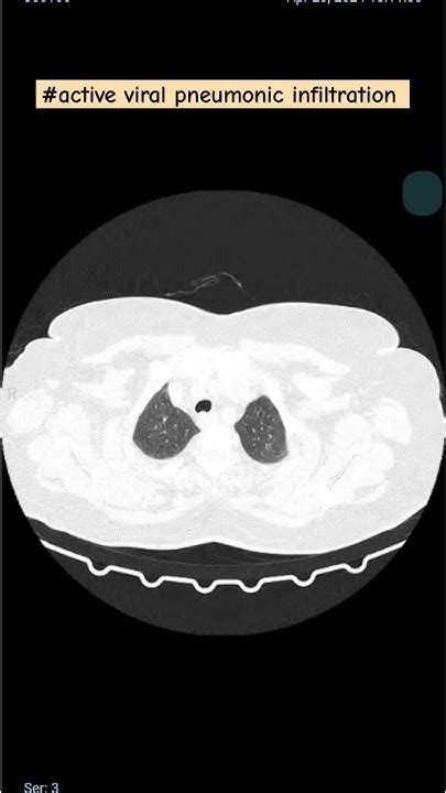 Active Pneumonic Infiltrationviralphenomenonviralinfectionsctscan