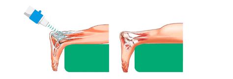benefits of shock wave therapy to treat achilles tendinopathy